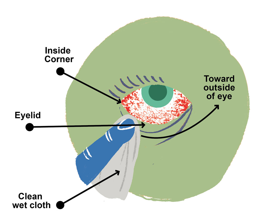 pink-eye - RN to BSN Online Programs